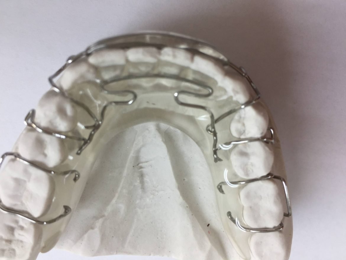 Spring Retainer | Jödicke - Fachlabor für Kieferorthopädie